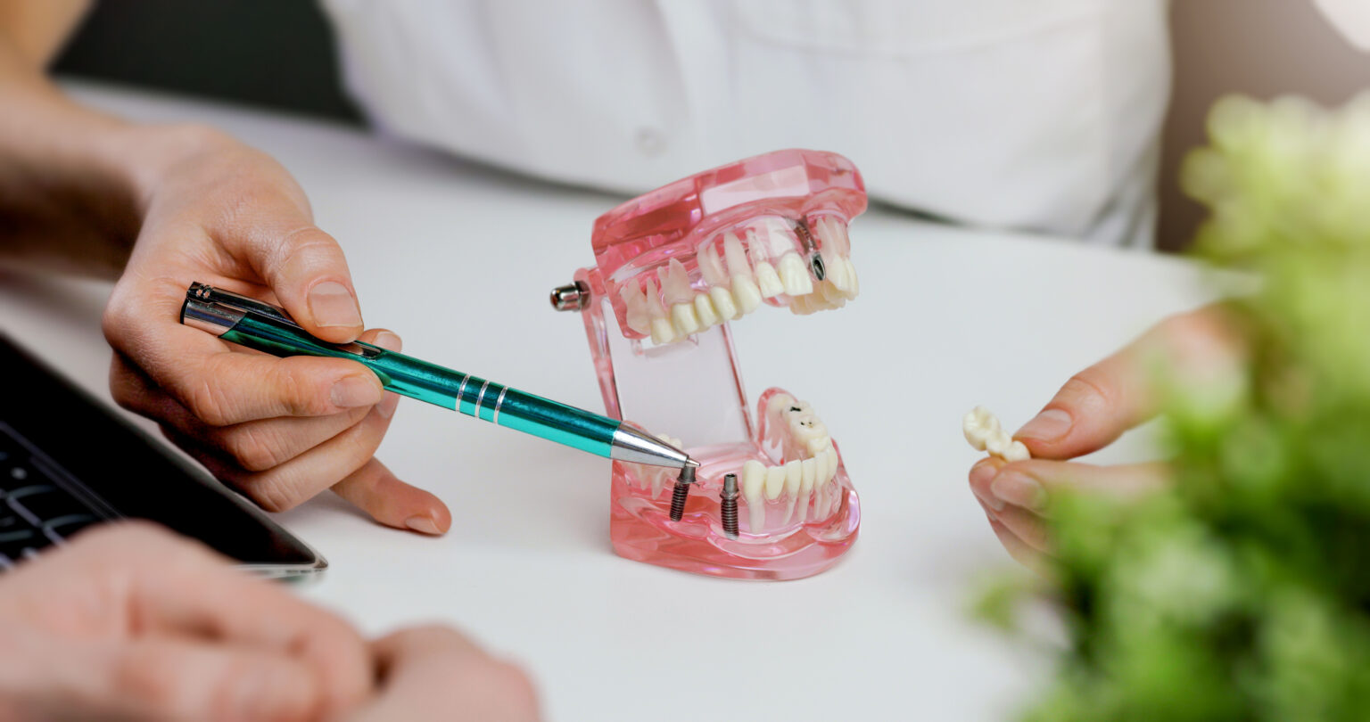 Longevity and Durability of Dental Implants